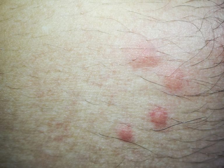 Why Are Fleas Attracted to Me? | BeatPests